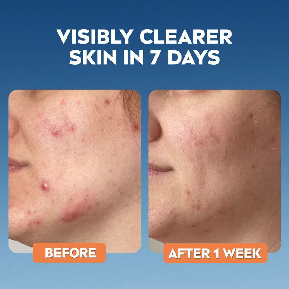 98757 Derma Skin Clear Anti-Blemish Scrub - NIVEA